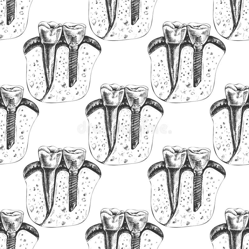 109_dental implant stock vector. Illustration of business - 220445598