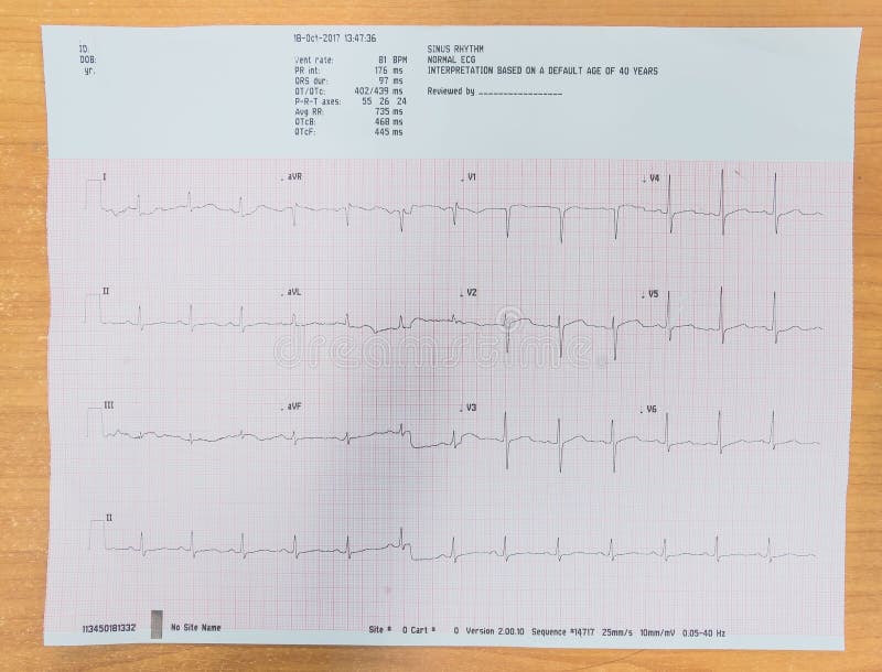 Heart Analysis, Electrocardiogram Graph ECG Stock Image - Image of ...
