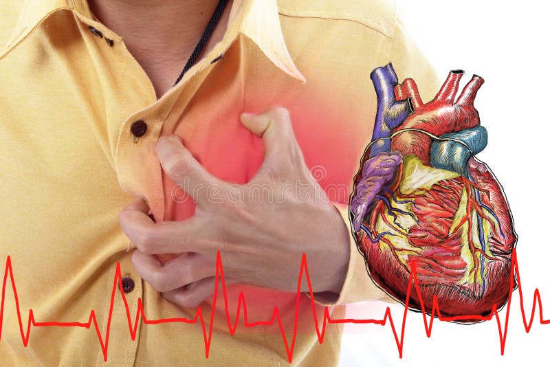 Heart Attack Concept by Use Hand Grabbing a Chest Stock Photo - Image ...