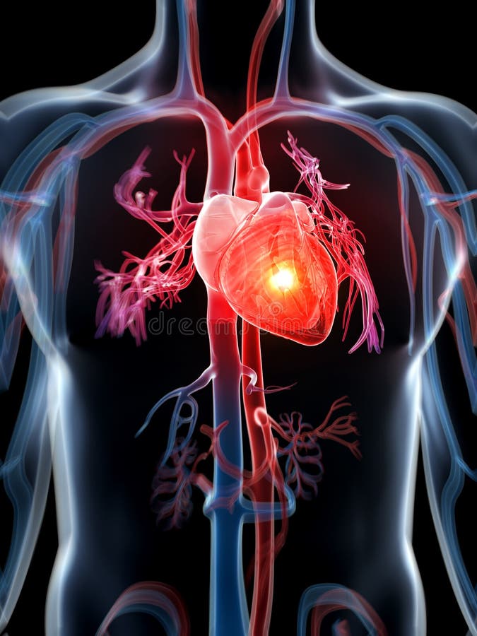Heart attack stock illustration. Illustration of disease - 8857696