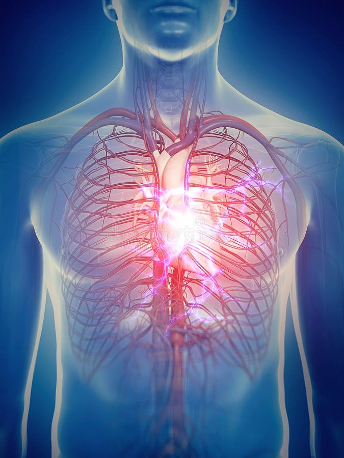 Heart attack stock illustration. Illustration of disease - 8857696