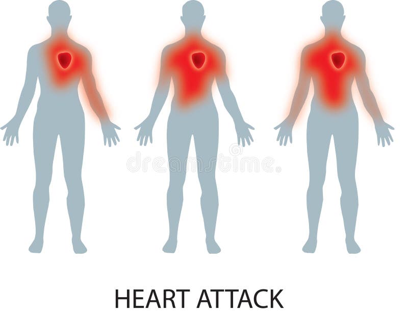 Heart attack stock illustration. Illustration of patient - 64494475