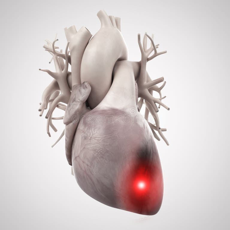 A heart attack stock illustration. Illustration of rendering - 74189885