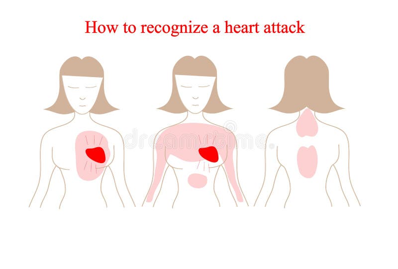 Heart Attack Vector Infographic Heart Attack Symptoms How To