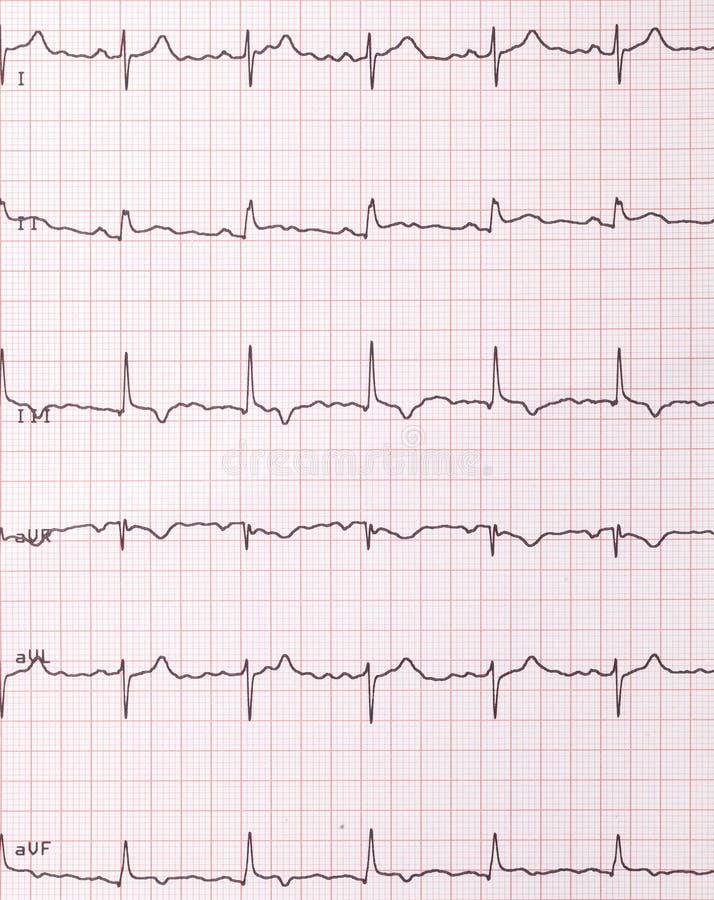 Heart beats cardiogram stock image. Image of graph, medicine - 77469187