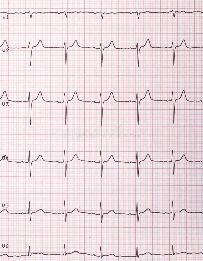 Heart beats on ecg stock image. Image of illness, rhythm - 158740111