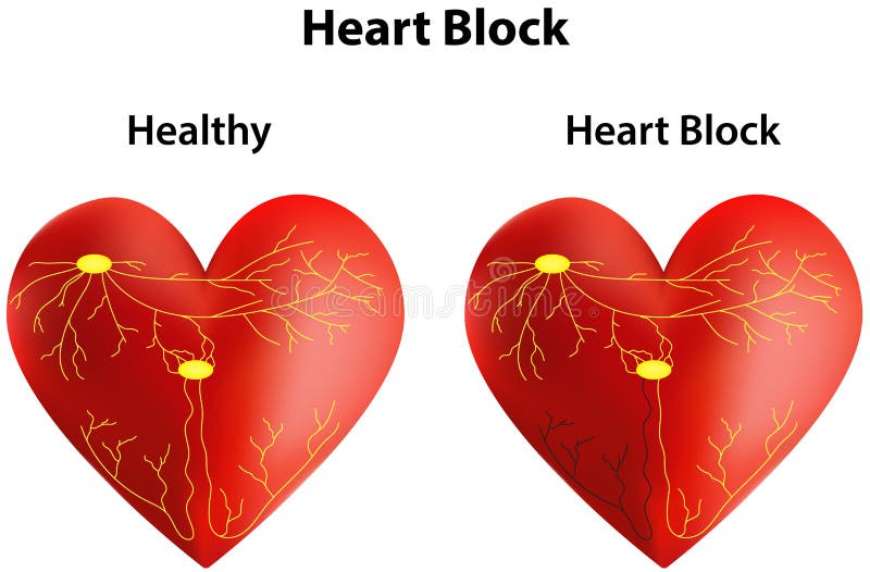 First Degree Atrioventricular Block Stock Illustrations – 6 First ...