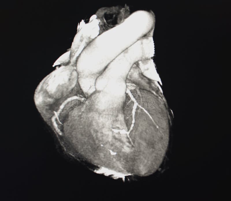 Heart Computed Tomography stock photo. Image of angiogram - 9798062