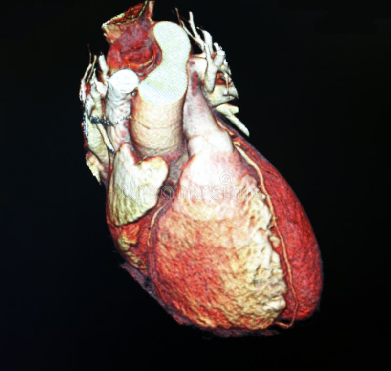 Heart Computed Tomography stock image. Image of magnetic - 9798139