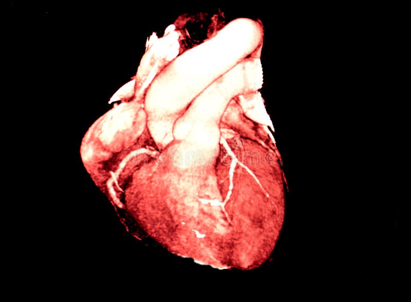 CT-Scan Heart stock photo. Image of negative, scan, heart - 17951270