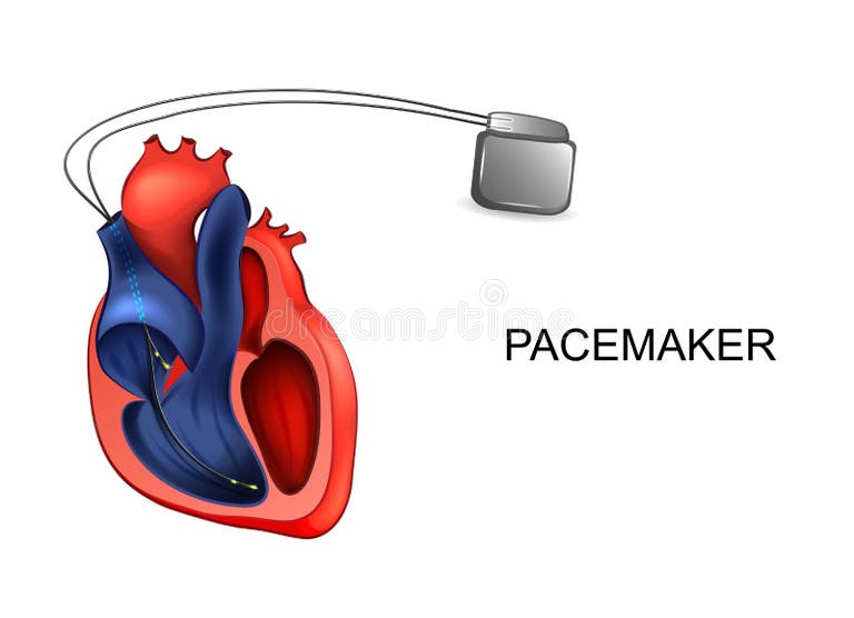 Heart and Pacemaker. Cardiology Stock Vector - Illustration of aortic ...