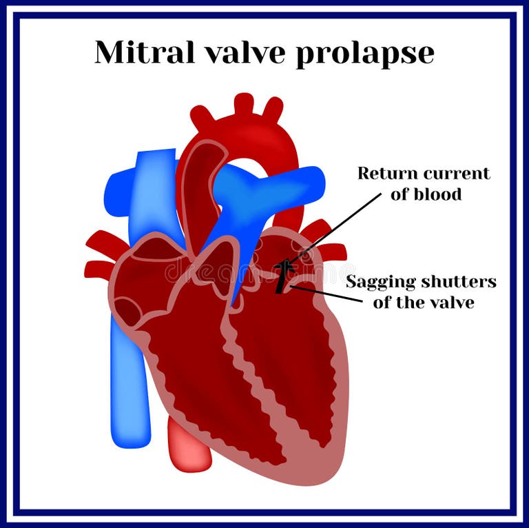 Mitral Valve Stock Illustrations – 297 Mitral Valve Stock Illustrations ...