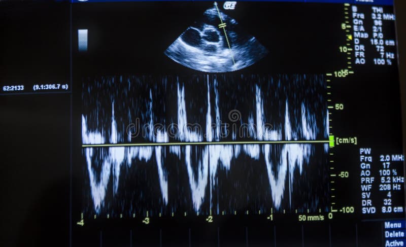 Heart Ultrasound Image on Computer Screen and Cardiogram. Stock Photo ...
