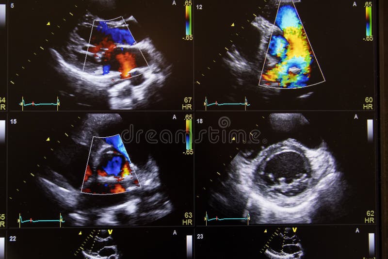 Heart ultrasound image stock image. Image of cardiology - 109814563