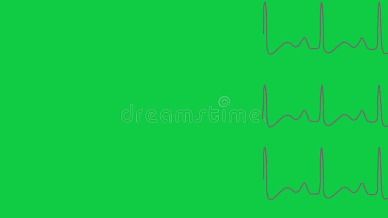 Medical ECG Heart Rate Screen Monitor Stock Footage - Video of health ...