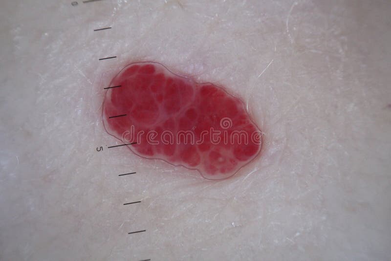 Contusions Et Taches De Sang Sous La Peau Qui Se Produisent Sur Des ...