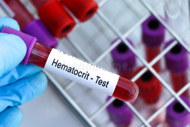 Hematocrit Test To Look for Abnormalities from Blood Stock Photo ...