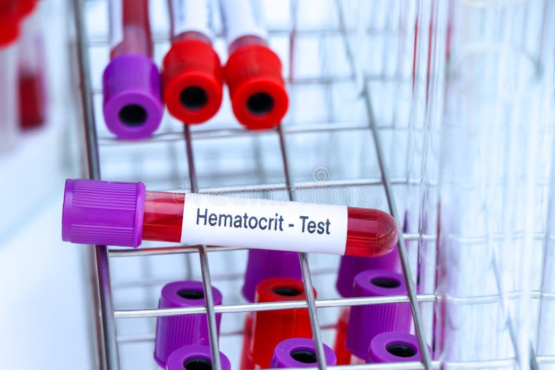 Hematocrit Test To Look for Abnormalities from Blood Stock Image ...