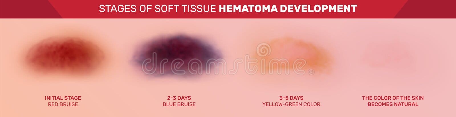 Hematoma. Stages stock vector. Illustration of hematoma - 89377392 Hematoma. Stages stock vector. Illustration of hematoma - 89377392