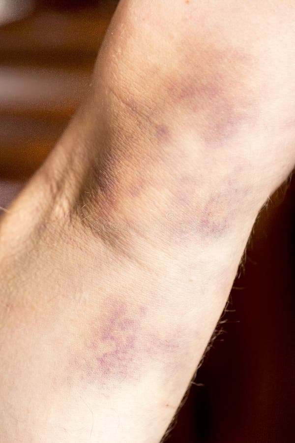 Hematoma Grande En El Brazo Humano Foto de archivo - Imagen de sangre ... Hematoma Grande En El Brazo Humano Foto de archivo - Imagen de sangre ...