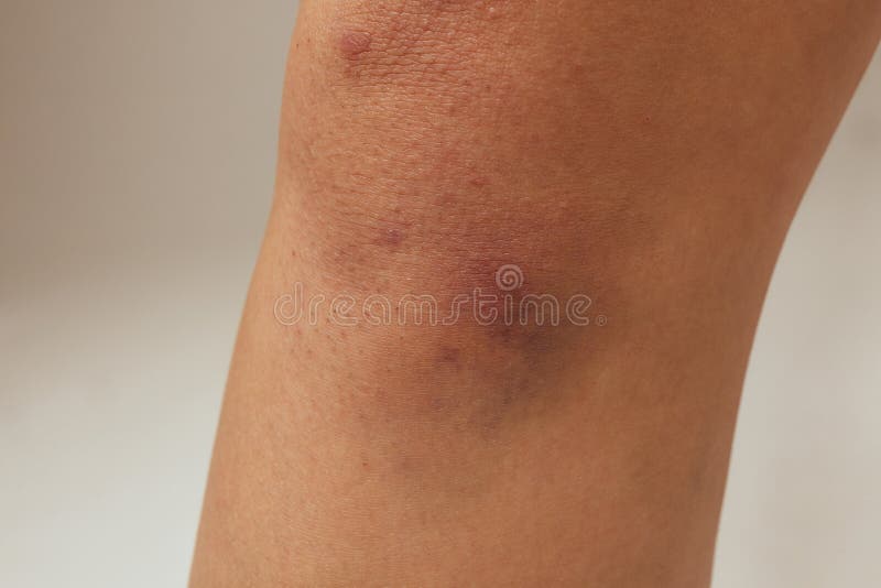 Hematoma and Large Bruise, Blood Under Skin Congestion. Stock Photo ...