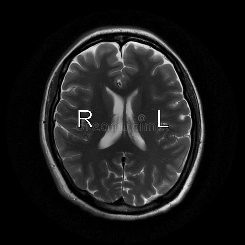 Normal Mri Brain Stock Photos - Free & Royalty-Free Stock Photos from ...