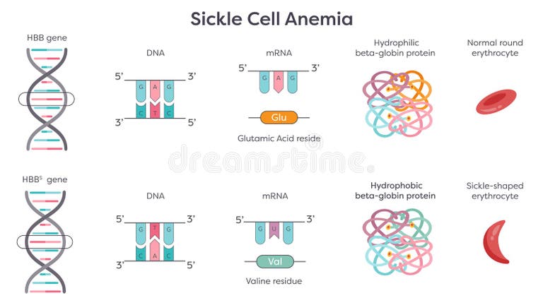 Sickle Cell Anemia HBB Point Mutation Graphic Stock Vector ...