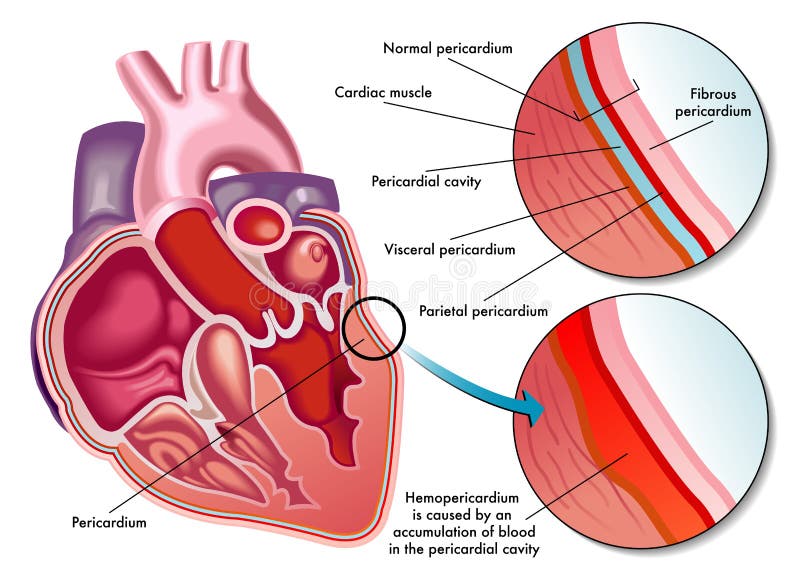 Hemopericardium Stock Vector - Image: 65683602