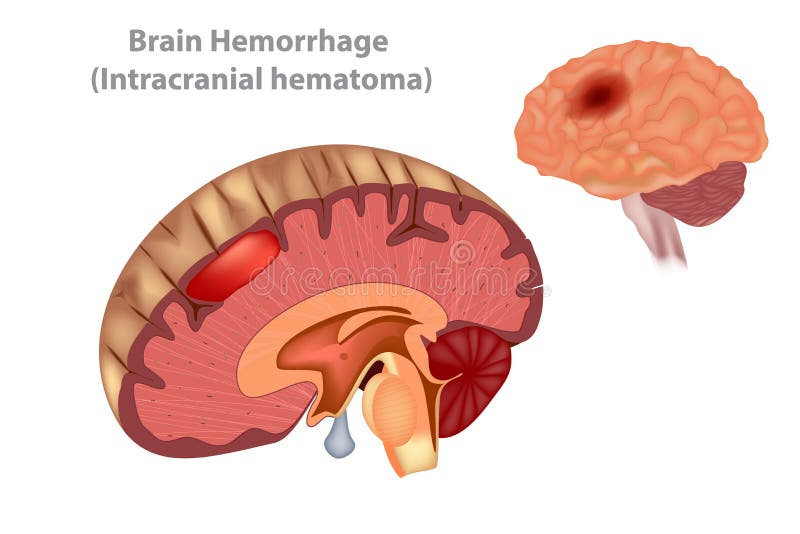 Hemorragia Cerebral Hematoma Intracraneal Ilustración del Vector ...