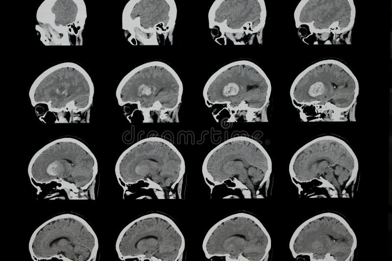 Hemorragia intracerebral imagen de archivo. Imagen de urgencia - 126488225