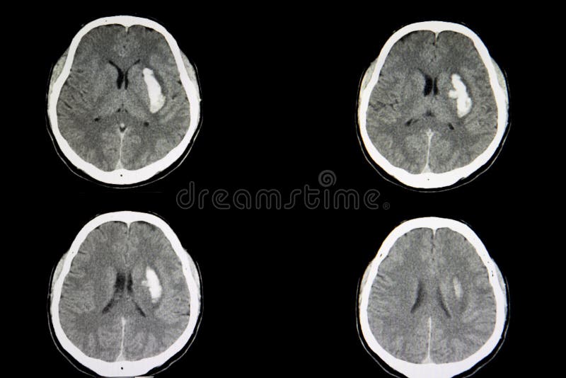 Hemorragia Intracerebral De La Exploración Del CT Imagen de archivo ...