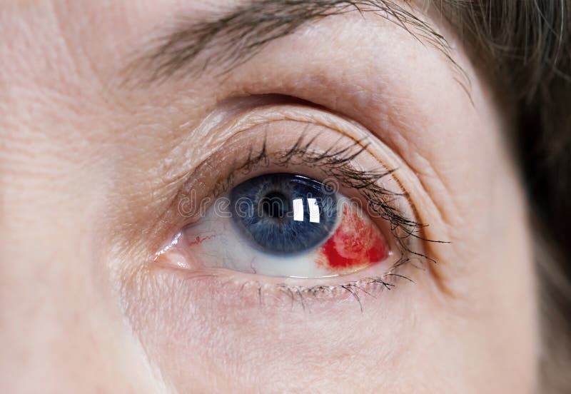 Hemorragia Subconjuntival - Hyposphagma Imagen de archivo - Imagen de ...