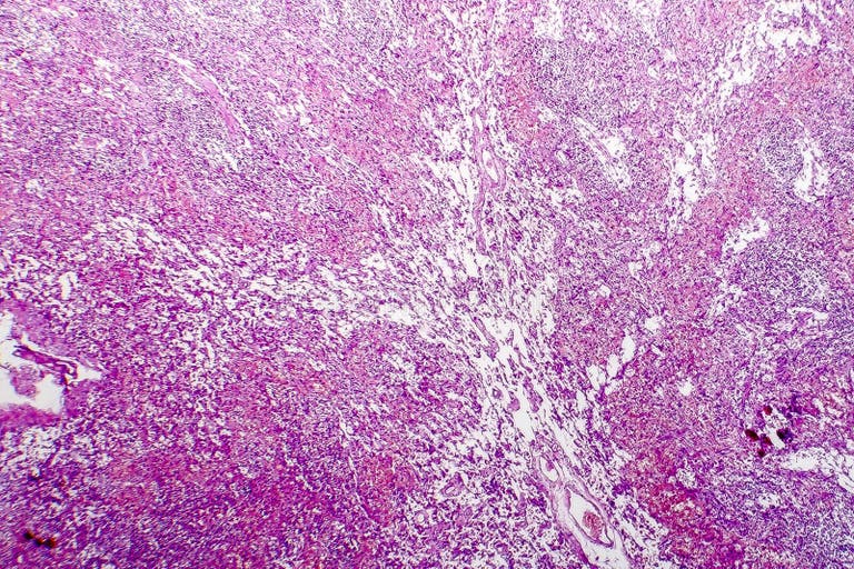 Lymph Node Under Microscope Stock Photos - Free & Royalty-Free Stock ...