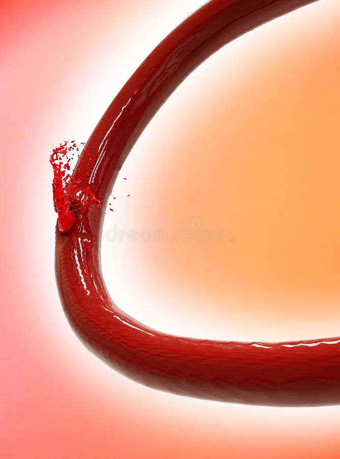 Ischemic Stroke. Thrombus Blood Clot in the Veins Artery Occlusion ...