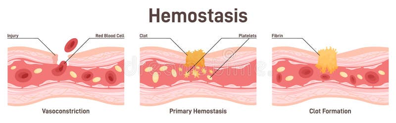 Hemostasis. Wound Healing Process Stages, Vasoconstriction and Stock ...