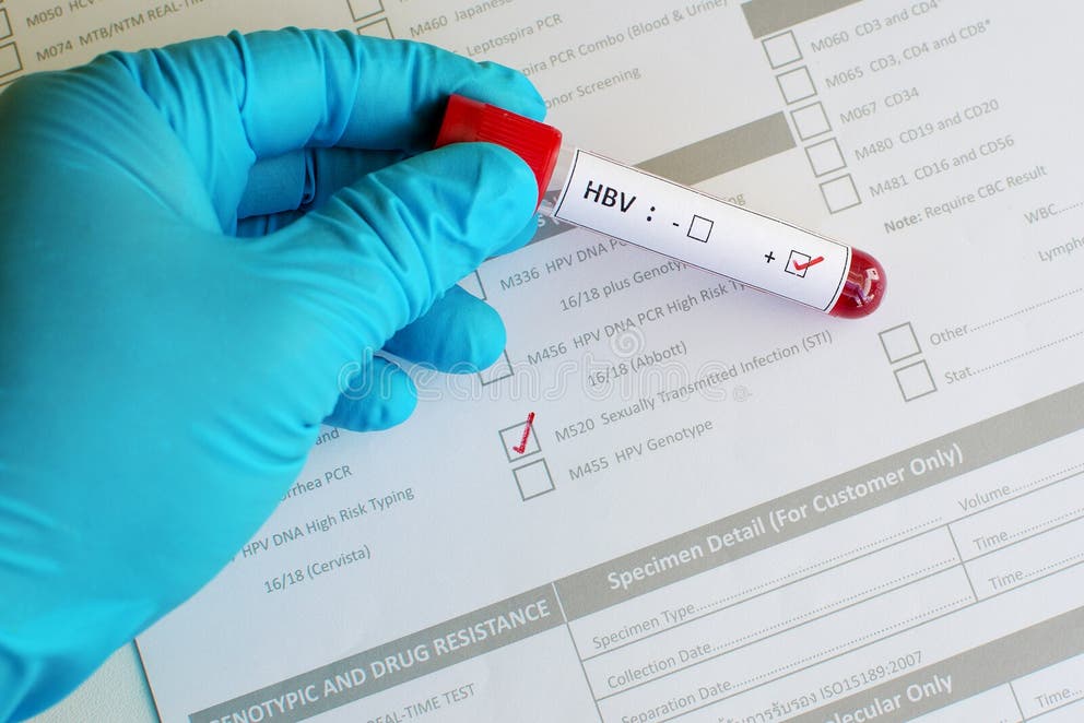Hepatitis B Virus (HBV) Positive Stock Photo - Image of science ...