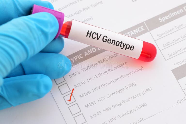 Hepatitis C genotype test stock image. Image of microbiology - 101369181