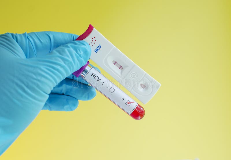 Hepatitis C Virus Positive Test Result Stock Image - Image of ...