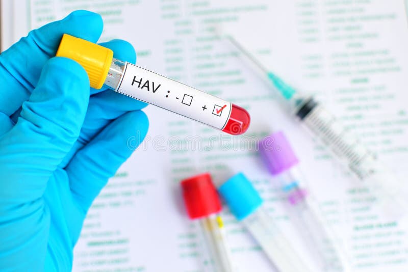 Hepatitis a Virus (HAV) Positive Stock Photo - Image of checkup, blood ...