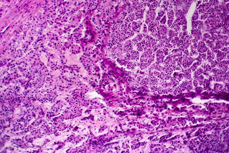 Hepatocellular Carcinoma, Light Micrograph Stock Photo - Image of ...