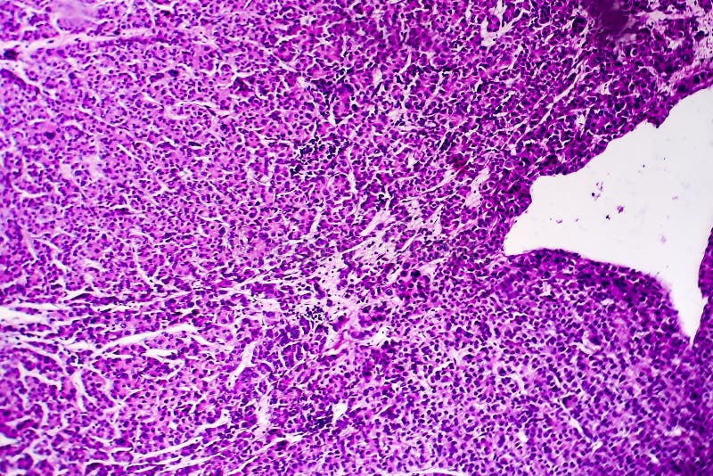 Hepatocellular Carcinoma, Light Micrograph Stock Image - Image of stain ...