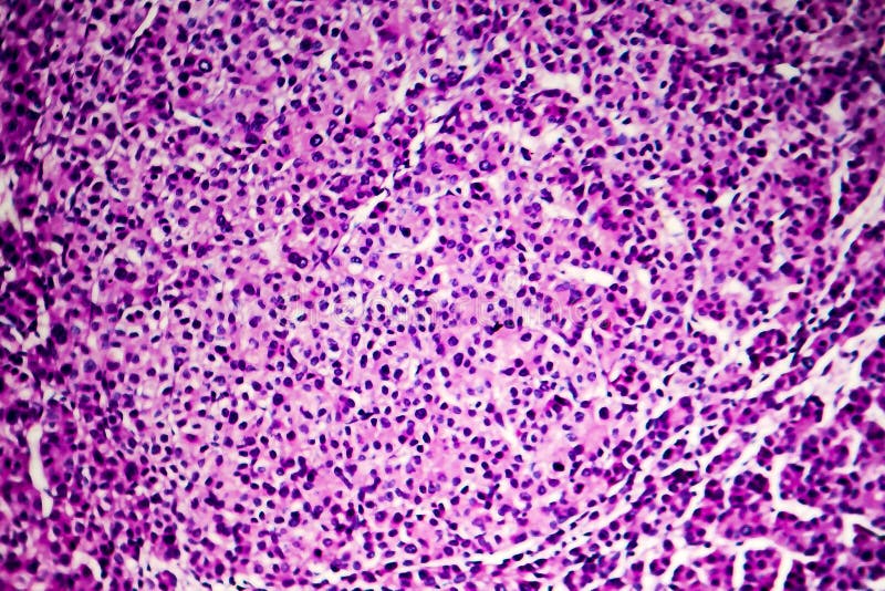 Hepatocellular Carcinoma, Light Micrograph Stock Image - Image of ...