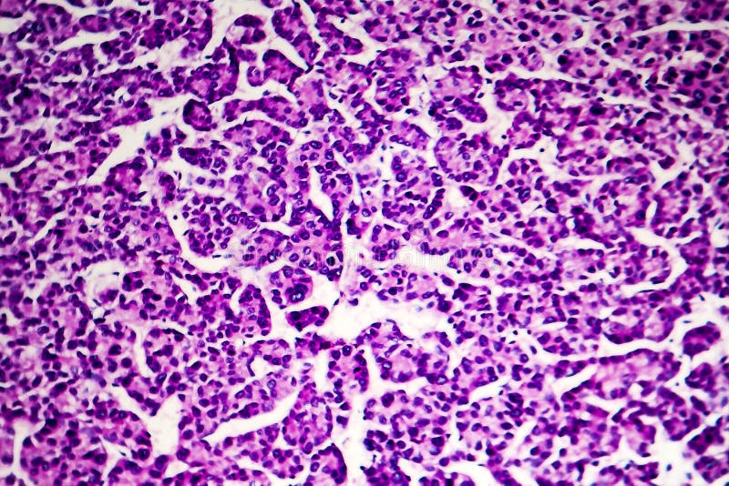 Hepatocellular Carcinoma, Light Micrograph Stock Image - Image of ...