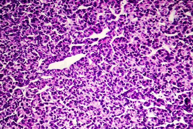 Hepatocellular Carcinoma, Light Micrograph Stock Photo - Image of ...