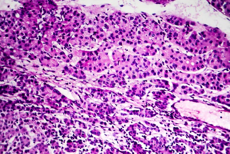 Hepatocellular Carcinoma, Light Micrograph Stock Photo - Image of ...