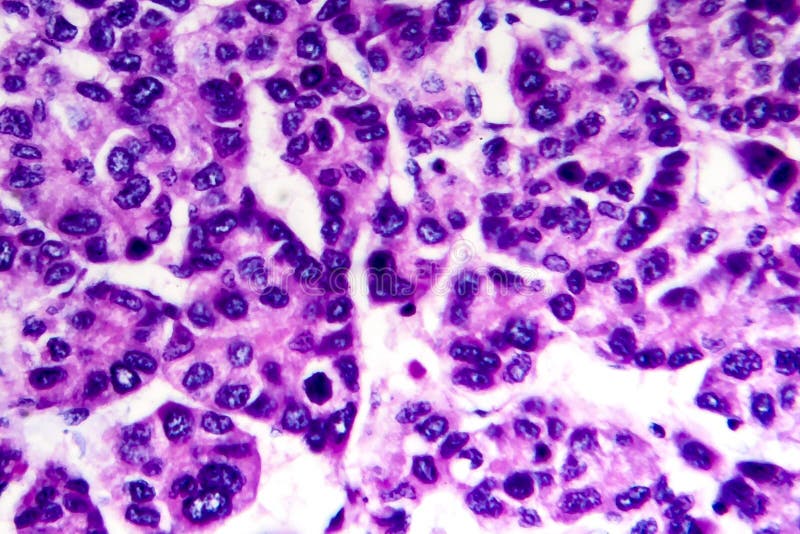 Hepatocellular Carcinoma, Light Micrograph Stock Image - Image of ...