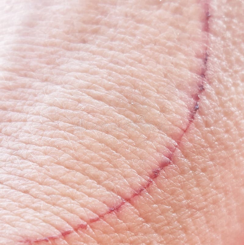 Herida cicatriz en la piel imagen de archivo. Imagen de manos - 158758645