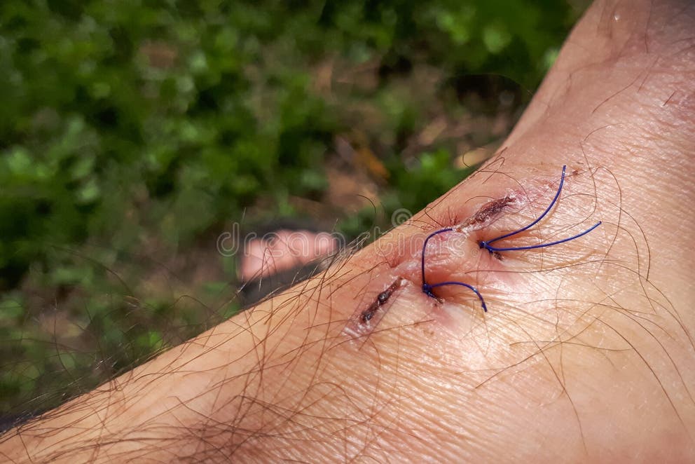 Herida cosida imagen de archivo. Imagen de hospital - 116958689