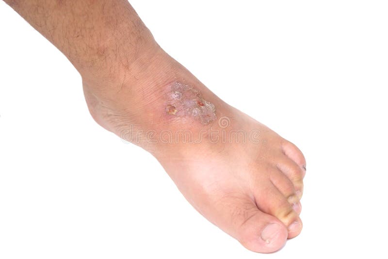 Herida infectada foto de archivo. Imagen de infección - 65108892