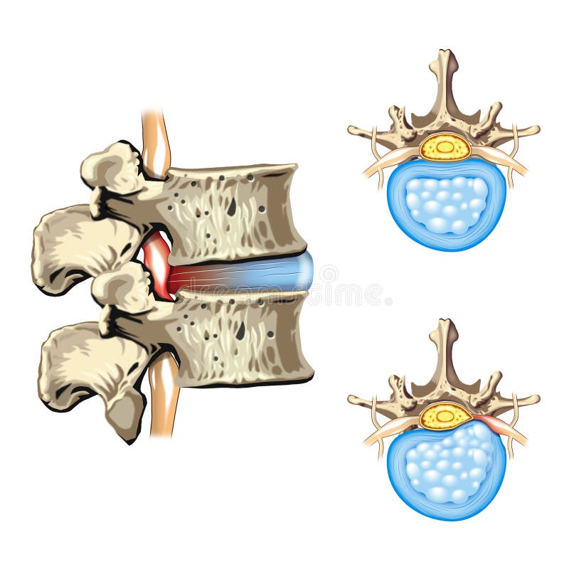 Herniated disc stock vector. Illustration of rehabilitation - 29459849